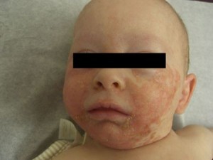 Acrodermatite - MedicinaLive