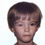 Sindrome di Russell-Silver - MedicinaLive