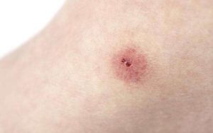 Ragno violino: morso, sintomi e cosa fare - MedicinaLive