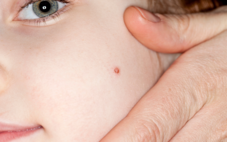 Verruche nei bambini: come riconoscerle e trattarle delicatamente ...