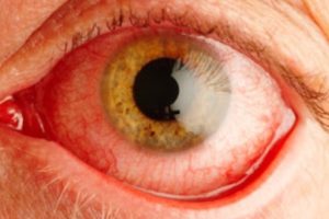 Occhi rossi: le cause più comuni e i principali rimedi